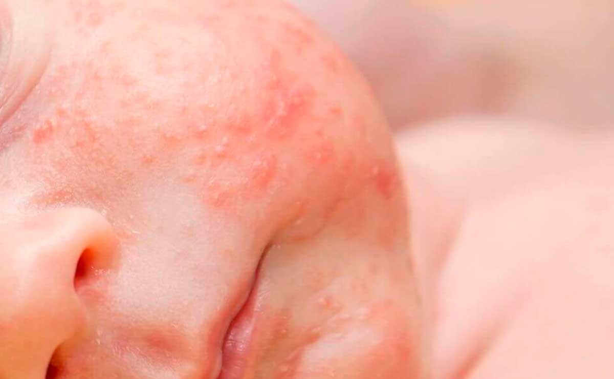 Acné neonatal: síntomas y tratamiento - Chapin TV